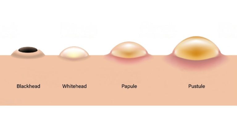 5 Gründe und Ursachen von Pickel: Warum entstehen Pickel eigentlich? [2026]
