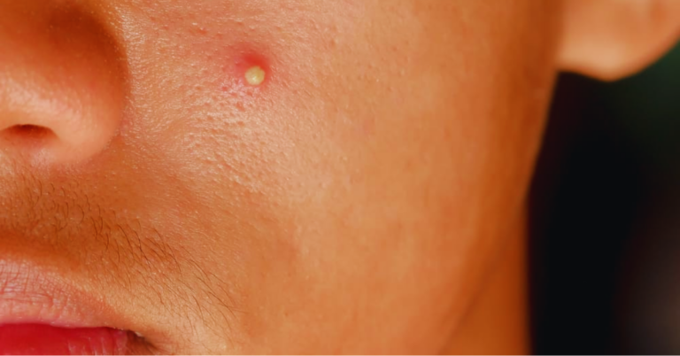 Eiterpickel: Entstehung, Behandlung und Vorbeugung [2026]