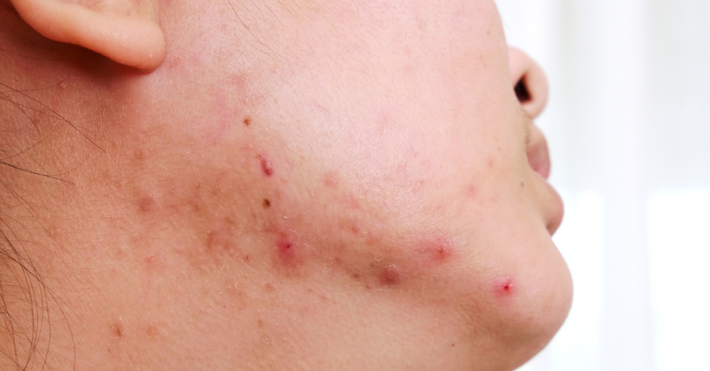 Pickel am Kinn: Ursachen & die besten Behandlungstipps [2025]