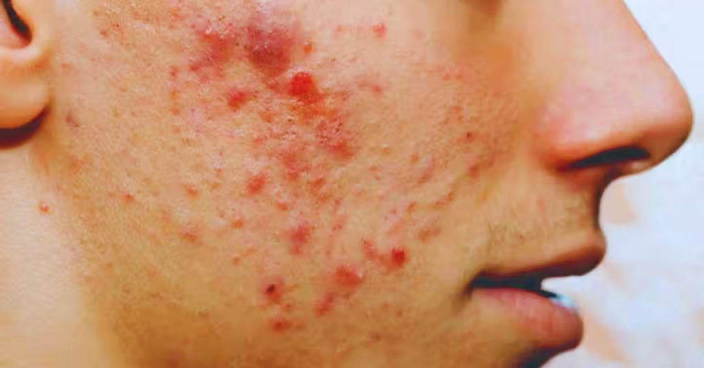 Pickel im Gesicht: Effektive Hausmittel und Pflegetipps [2025]