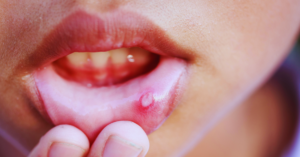 Pickel im Mund: Ursachen, Behandlung + Empfehlungen [2026]