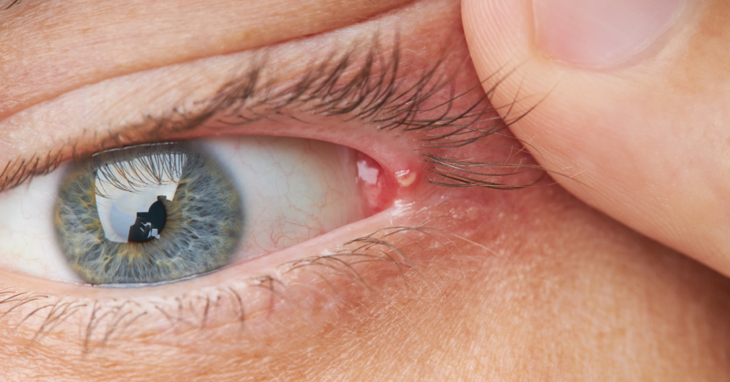 Pickel im Auge: Ursachen & Behandlung + Empfehlung [2025]