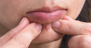 Unterirdische Pickel loswerden: Tipps & Behandlungen [2026]