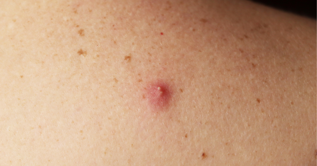 Großer Pickel am Rücken: Ursachen und Behandlung + Tipps [2025]