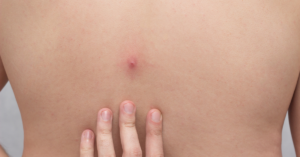 Großer Pickel am Rücken: Ursachen und Behandlung + Tipps [2025]