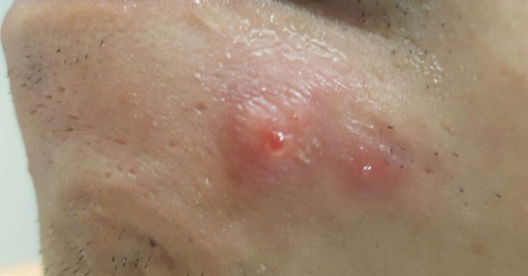 Pickel unter der Haut: Ursachen und effektive Behandlungen [2026]