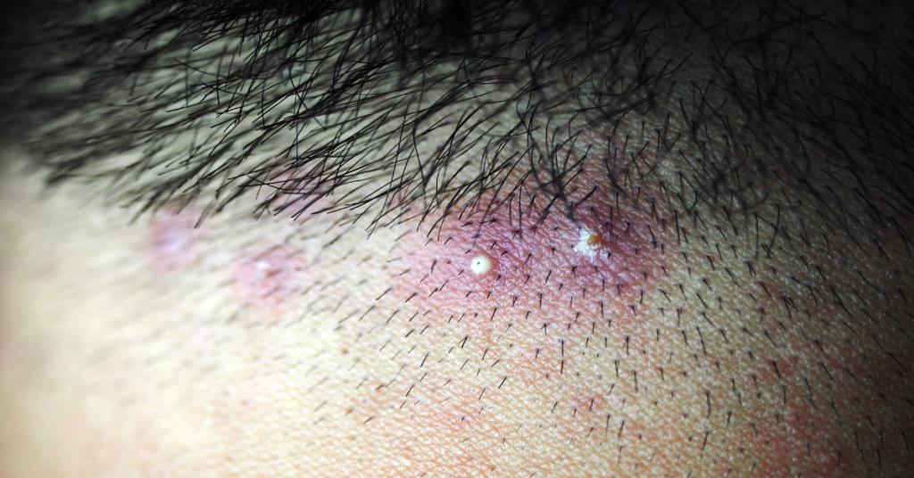 Pickel auf der Kopfhaut: Gefährlich oder harmlos? [2025]