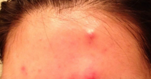 Pickel auf der Stirn loswerden: Effektive Tipps und Hautpflege-Routinen ...