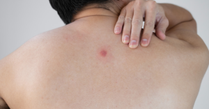 Juckende Pickel am Rücken: Ursachen, Behandlung & Tipps zur Vorbeugung ...