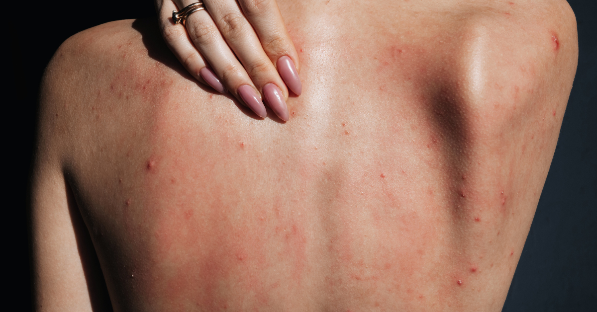 Juckende Pickel am Rücken: Ursachen, Behandlung & Tipps zur Vorbeugung ...