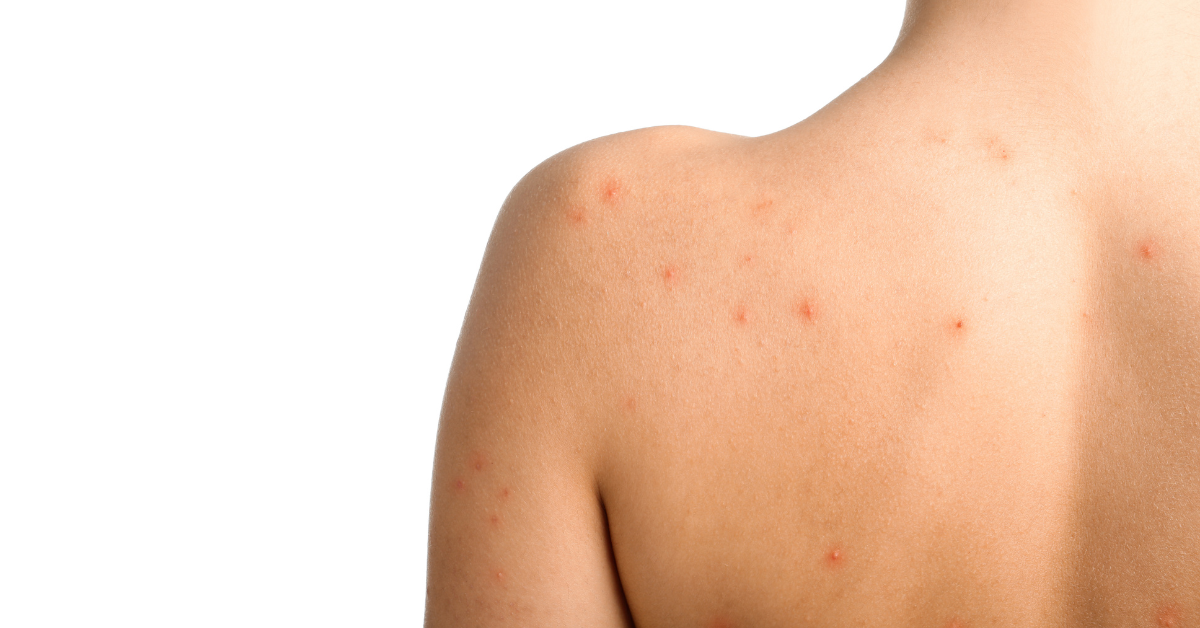 Plötzlich Pickel am Rücken? Ursachen und Lösungen für reine Haut [2026]