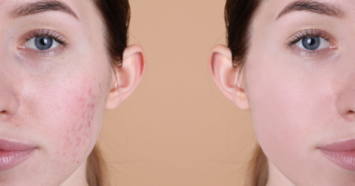 Pickel auf der Wange loswerden: Effektive Tipps und Methoden für reine ...