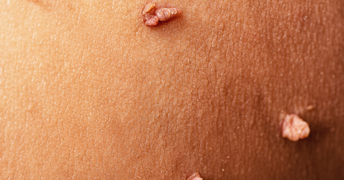 Beste Cremes gegen Feigwarzen im Test: Vergleich + Empfehlungen [2025]
